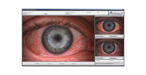 OCULUS Keratograph 5M Advanced Corneal Topographer