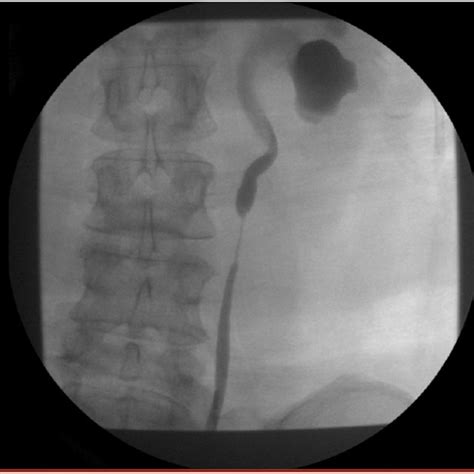 Retrograde Pyelogram Seven Months Following Left Ureteral Stent Download Scientific Diagram