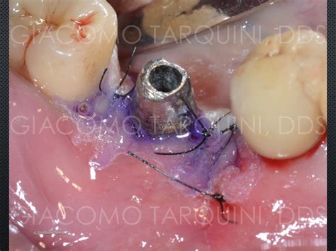 Peri Implantiti Approccio Resettivo Con Limpiego Di Piezoclean By Dr