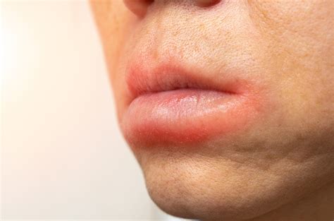 Ini 5 Penyebab Bibir Bengkak Dan Cara Ampuh Mengatasinya