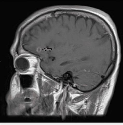 Sagittal T1 Weighted Magnetic Resonance Imaging Of The Initial 07 Cm