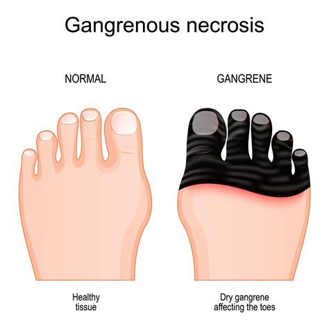 What Is Gangrene A Comprehensive Guide To This Serious Condition