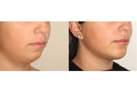7 Chin Augmentation And Liposuction Dr Denton
