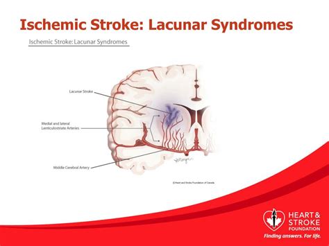 Lacunar Stroke
