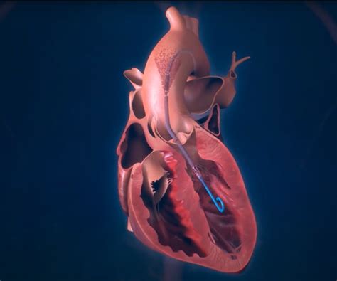 Abiomed Impella Opsens Medical