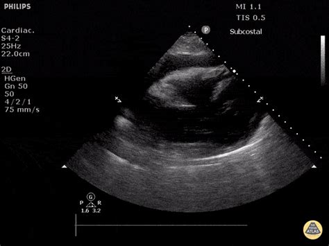 Pericardial Disease — Tpa