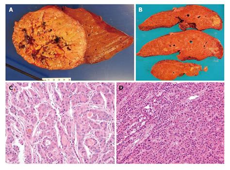Hepatocellular Carcinoma Gross