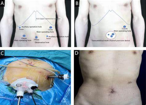 Laparoscopic Partial Gastrectomy Cpt Code