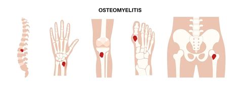 Premium Vector Osteomyelitis Disease Common Cases Infected Bones Of