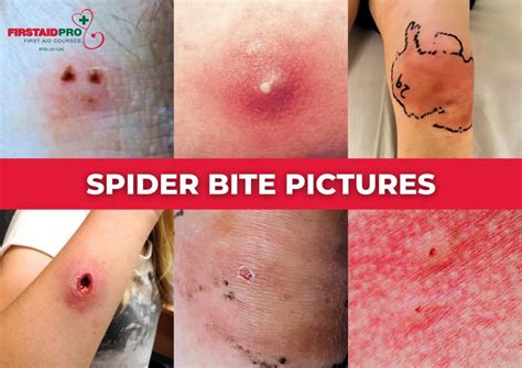 Spider Bites