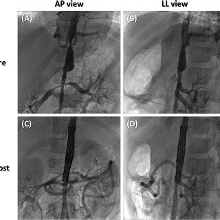Still Angiographic Frames Of Preoperative Scenario A B And