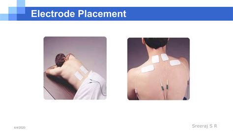 Transcutaneous Electrical Nerve Stimulation Tens Srs Pptx