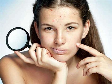 How To Get Rid Of Acne Scars And Pimple Marks Naturally