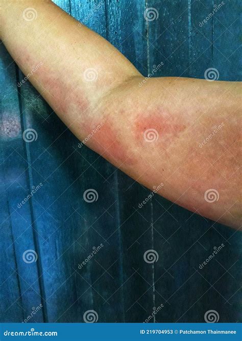 Close Up Shot Of Scars Red Itchy Rashes On Arms Of Asian Women Skin Disease Or Allergy