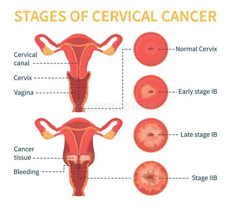 Ectropion Of Cervix Atlas Of Visual Inspection Of The Cervix With