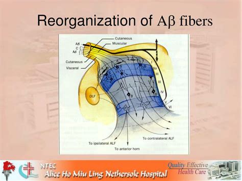 Ppt Neuropathic Pain Powerpoint Presentation Free Download Id5602702