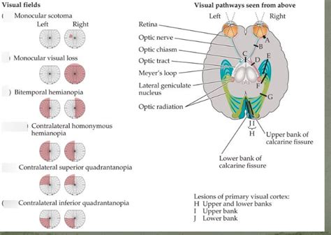 Lesions Of Primary Visual Pathway Diagram Quizlet