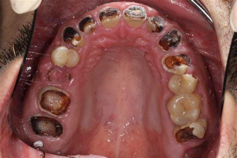 Michael 32 Drack Läsk Varje Dag Så Här Såg Hans Tänder Ut