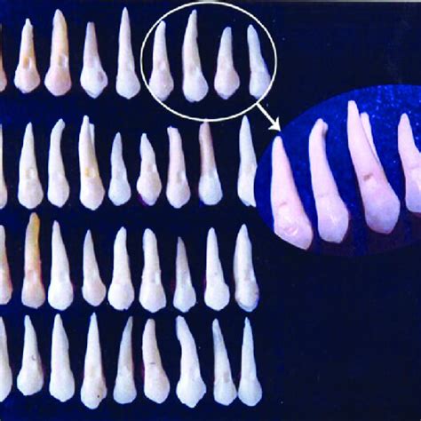 Direct Composite Resin Inlays Download Scientific Diagram
