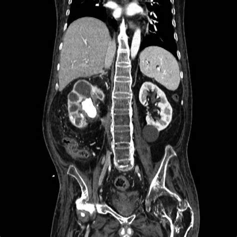 Enhanced Axial Ct Image Showing A Perinephric Fluid Collection And The
