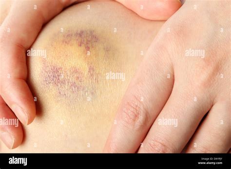 Ginocchio Gonfio Immagini E Fotografie Stock Ad Alta Risoluzione Alamy
