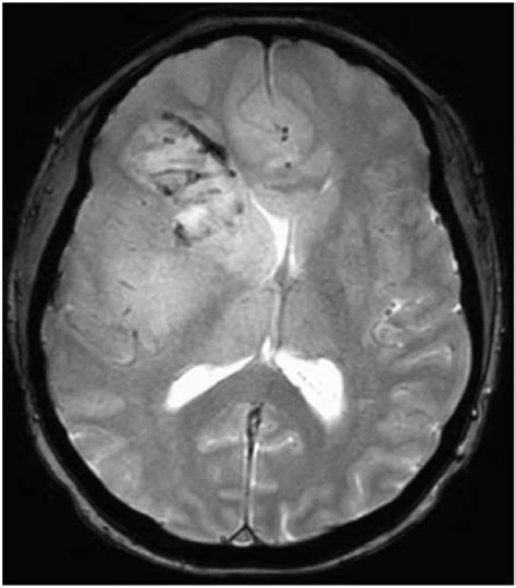 Axial Mri Flair Weighted Image At The Level Of Basal Ganglia