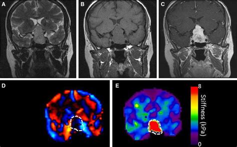 A 73 Year Old Female With Metastatic Adenoid Cystic Carcinoma On Download Scientific Diagram