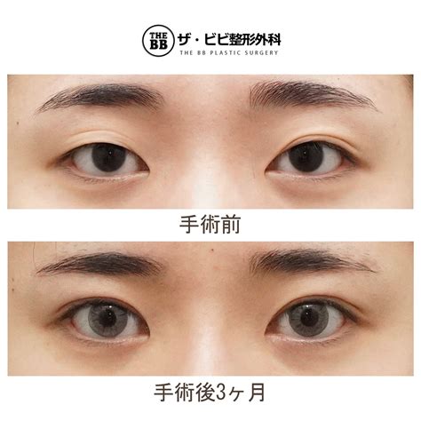 【目整形手術症例】ザ・ビビ整形外科 二重の左右差調整症例 ザ•ビビ美容外科のブログ