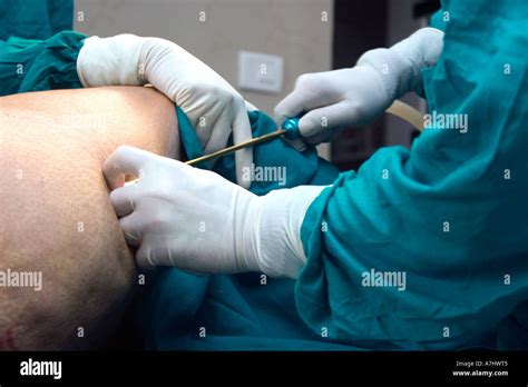 Fat Loss By Liposuction Surgeries Has Become Very Common These Days