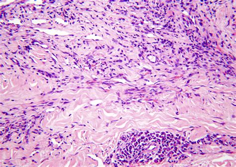 Pathology Outlines Kaposi Sarcoma