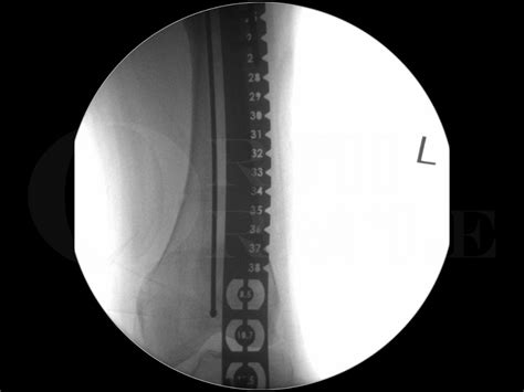 Open Femoral Fracture Bone Defect Treated With The Precice Bone