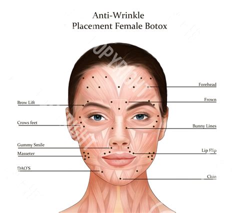 Botox Injection Points On Muscle Anatomy Botox Filler Injector