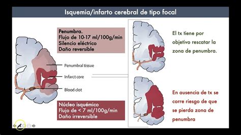 Enfermedad Vascular Cerebral Parte 1 Youtube
