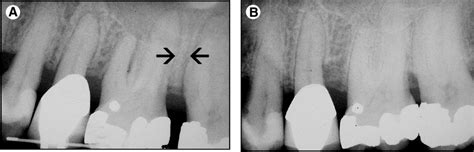 A Note The Widened Interproximal Space Between Arrows And B