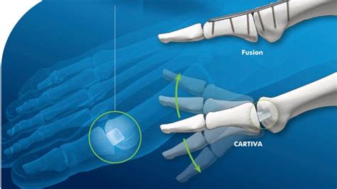Synthetic Cartilage Is Now An Option For Big Toe Arthritis Sufferers