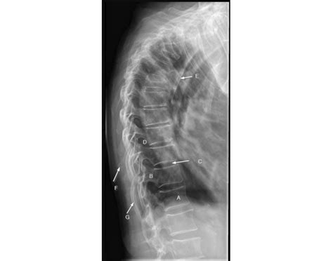 Thoracic Spine Xray