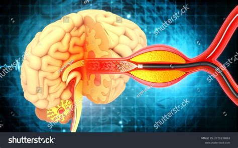 정맥에 스텐트가 있는 풍선 혈관 성형술3d 스톡 일러스트 2070139883 Shutterstock