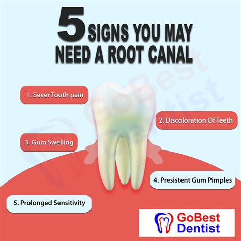 Root Cannal Treatment Gobest Dentist