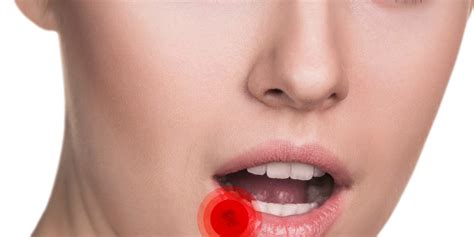 Dentists Advice On How To Quickly Eliminate Canker Sores