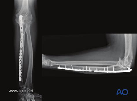 Open Reduction Internal Fixation For Anterior Transolecranon Fracture Dislocation