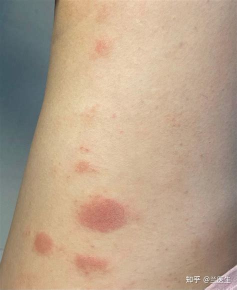 大腿内侧瘙痒有红斑越来越大是什么病，怎么治？ 知乎