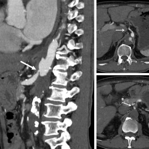 Preoperative Ct Angiography Shows Extensive Occlusion From The Sma To