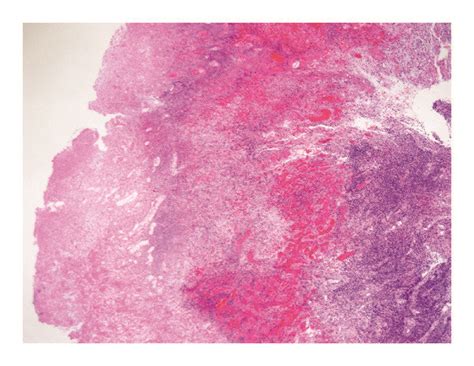 Morphological Features Of Nasal Tumor A Low Power View Shows Diffuse