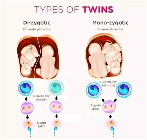Types Of Twins Medizzy