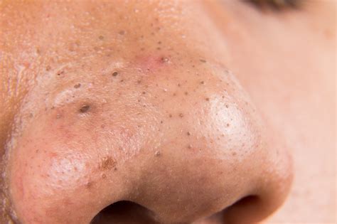 Blocked Pores On Lip Line