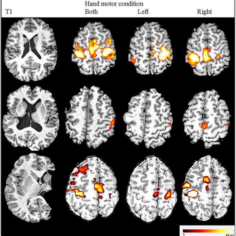 Three Participants Images From Structural And Functional Mri From