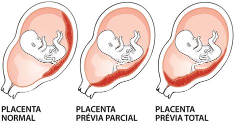 Saiba o que é placenta prévia