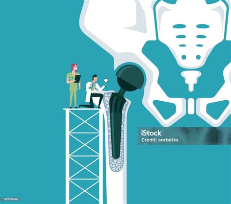 Struktur Sendi Pinggul Buatan Ilustrasi Stok Unduh Gambar Sekarang