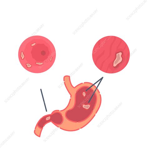 Peptic Ulcer Conceptual Illustration Stock Image F0414572 Science Photo Library