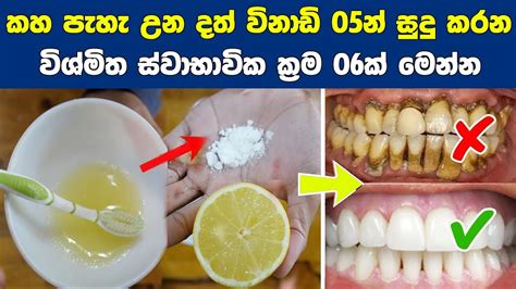 අව පැහැ දත් විනාඩි 05න් සුදු කරන ස්වාභාවික ක්‍රම 06ක් මෙන්න Top 06